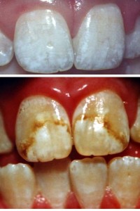 Fluorose: Como Tratar? - Medo de Dentista