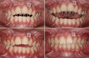 Pra quê serve a grade lingual? - Medo de Dentista