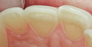 Erosão Ácida: Causas e Prevenção - Medo de Dentista