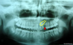 Tracionamento de Caninos Impactados - Medo de Dentista