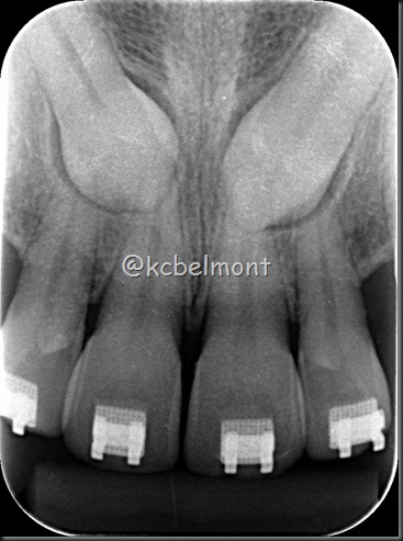 Tracionamento de Caninos Impactados - Medo de Dentista